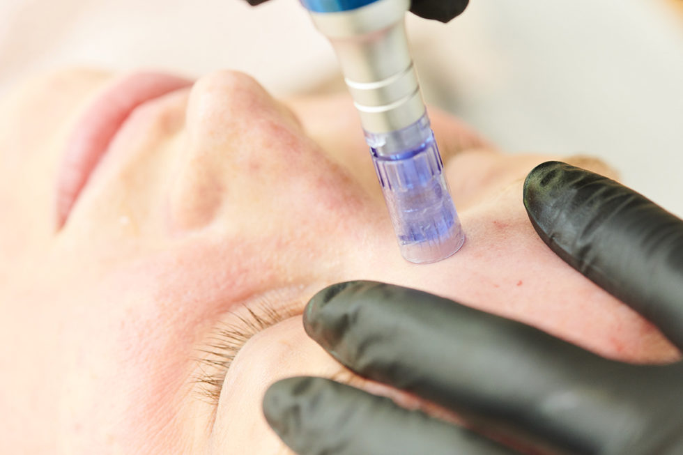 Microneedling besticht durch Höchstleistung. Kosmetik in Saarbrücken.